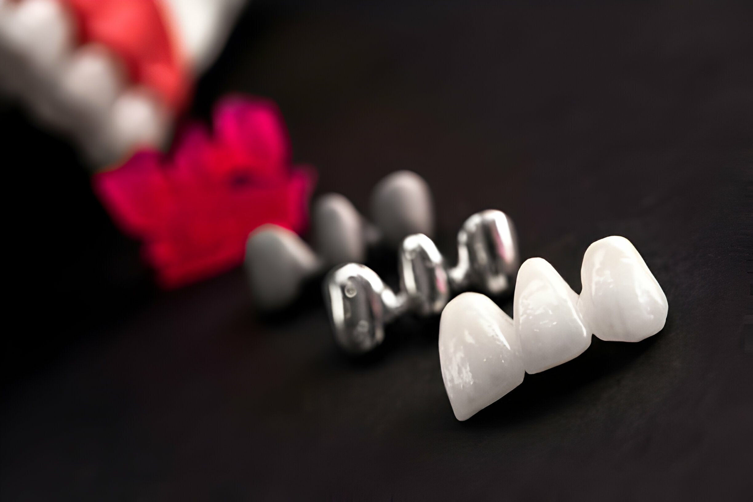 Tupelo EMAX Veneers: Find Your Perfect Smile With A Local Dentist